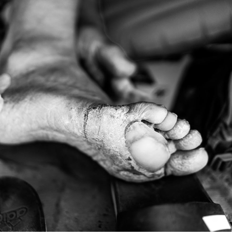 When To Change Your Blister Dressing