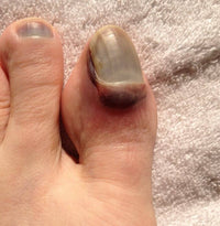 Blister Under Toenail | Toenail Blisters: Causes & Treatment